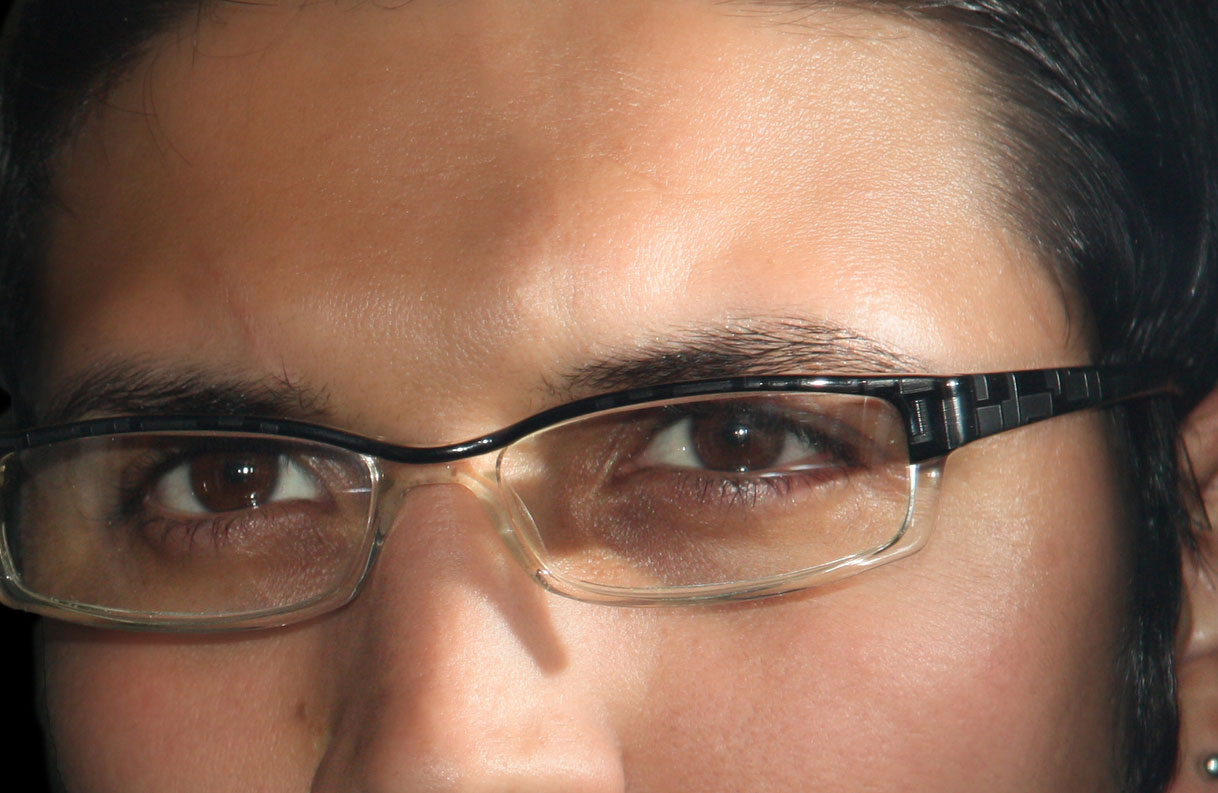 Botulinum toxin for cosmesis in the peri-ocular region | Consultant ...