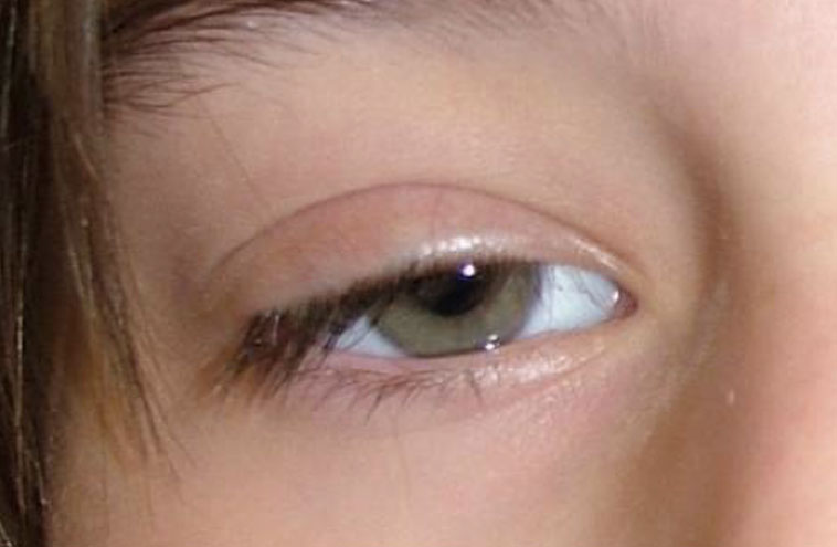 Ptosis Surgery | Consultant Ophthalmologist Nottingham